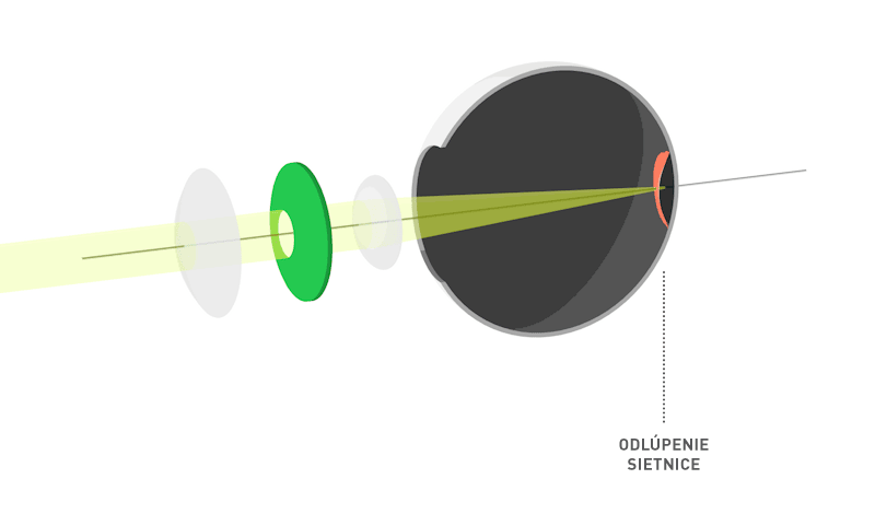 Ochorenia sklovca a sietnice - Očná klinika UVEA
